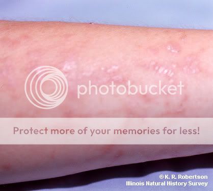 Wild Parsnips RASH Photo by bucshott | Photobucket